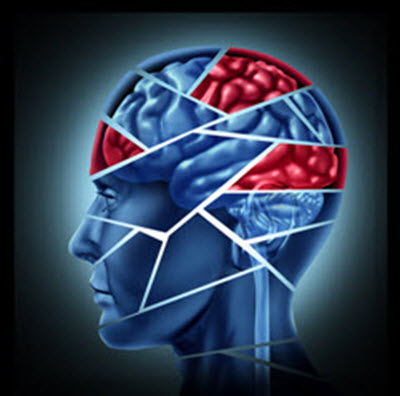 Compensation For Traumatic Brain Injuries In Pinellas County